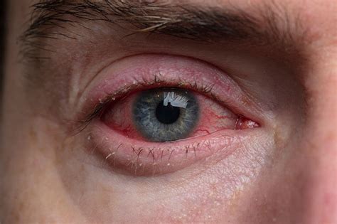 Staph Infection In Eye