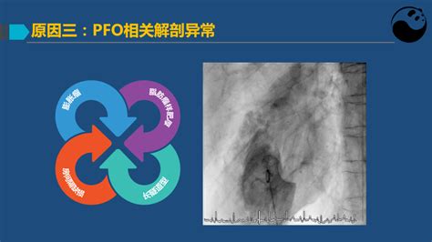 Pfo封堵术后残余分流的诊断及处理 好医术文章 好医术 赋能医生守护生命
