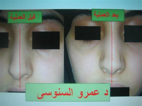 ‫أجزاء الأنف وقياساتها قبل إجراء العملية Facebook‬