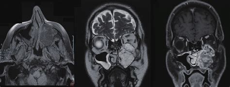 Magnetic Resonance Images A Axial T1 Weighted Fat Suppressed Image