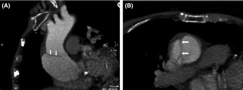 Sagittal‐oblique Reformatted Image A And Transverse‐axial Section B