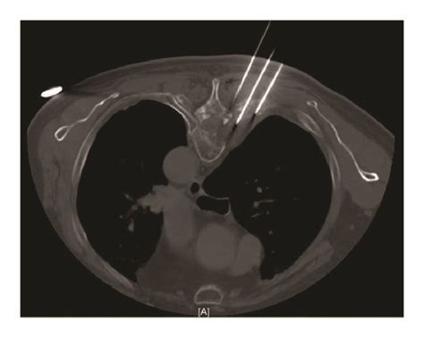 Representative Ct Scans Of A Patient During ¹²⁵i Brachytherapy A Download Scientific Diagram