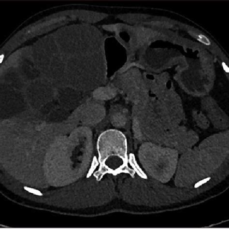 Axial Ct Scan With Rectal Contrast And Intravenous Contrast