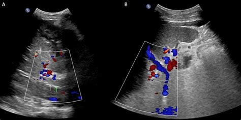 Doppler Ultrasound Demonstrating Portal Vein A And Splenic Vein B