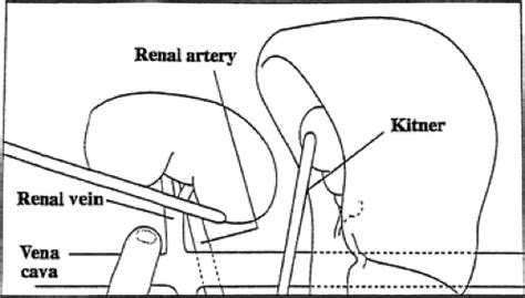 Hand Assisted Laparoscopic Donor Nephrectomy Basicmedical Key