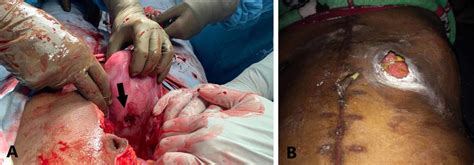 A The Defect Seen On The Posterior Wall Arrow Of Uterus Download Scientific Diagram