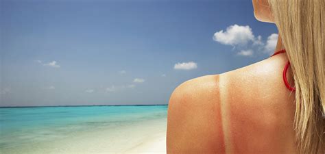 How To Treat A Sunburn Louisville Ky Uofl Health
