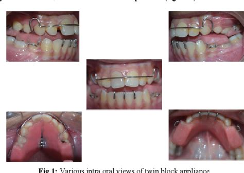 Class Ii Div I Occlusion Roseanna Nava