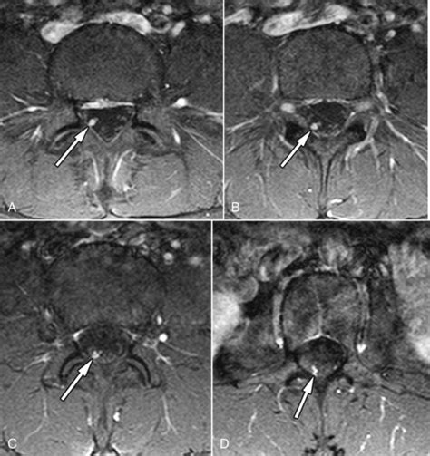 Intrathecal Radiculitis Radiology Key
