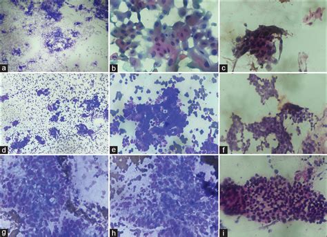 Fine Needle Aspiration Cytology Of Gallbladder With An Attempt Of
