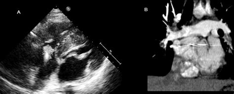 Transthoracic Echocardiography A Showing A Thrombus Marked Adherent Download Scientific