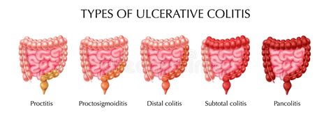 Colorectal Polyp And Polypectomy Stock Vector Illustration Of