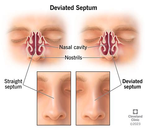 Deviated Septum Symptoms Outlet