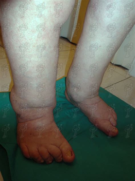 Conceptos básicos del linfedema Institut Català del Peu