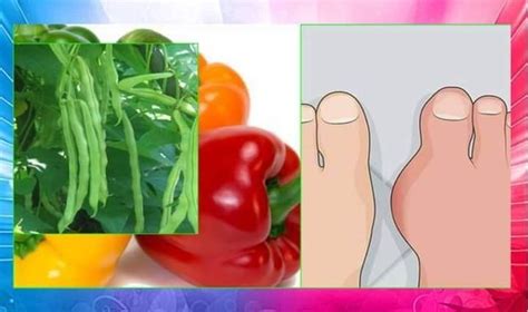 ဂေါက်ရောဂါ ကို အစားအစာနဲ့ ကုမယ်