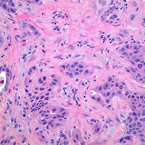 Peripheral Intrahepatic Cholangiocarcinoma Radiology Key