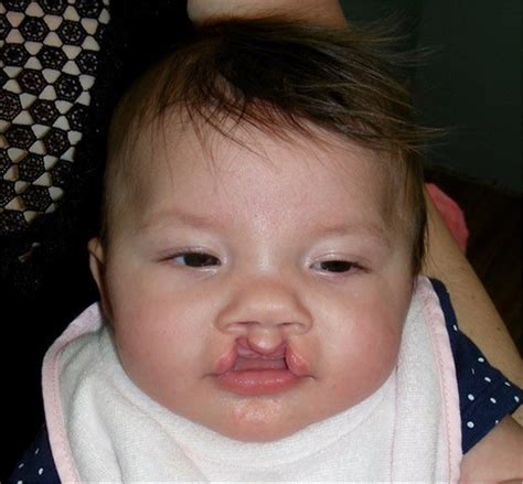 Bilateral Cleft Lip And Palate Before And After