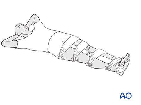 Traction For Extraarticular Fracture Simple