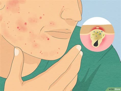 How To Tell If Your Acne Is Hormonal Or Bacterial