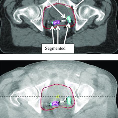 Recommendation Of Nonuniform PTV Margins For Prostate Bed In 3