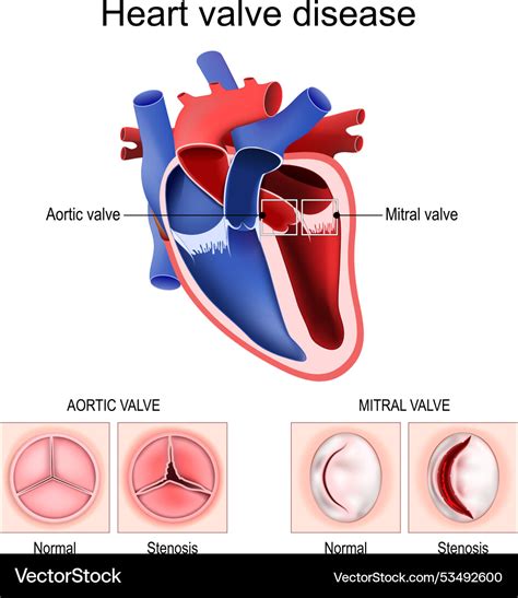 Heart Valve Anatomy And Stenosis Royalty Free Vector Vectorstock