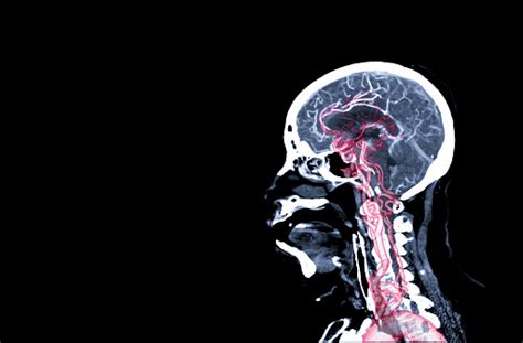 Ct Angiografi Otak Atau Cta Otak Pandangan Sagital Foto Stok Unduh