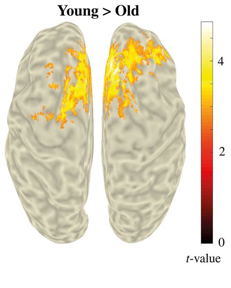 Group Differences Of The β‐power Averaged Over Motor Execution