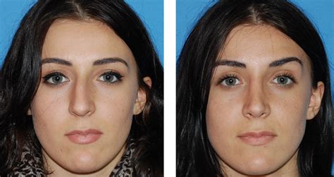 Deviated Septum Causes Symptoms Diagnosis Treatment Recovery And Overview Scope Heal