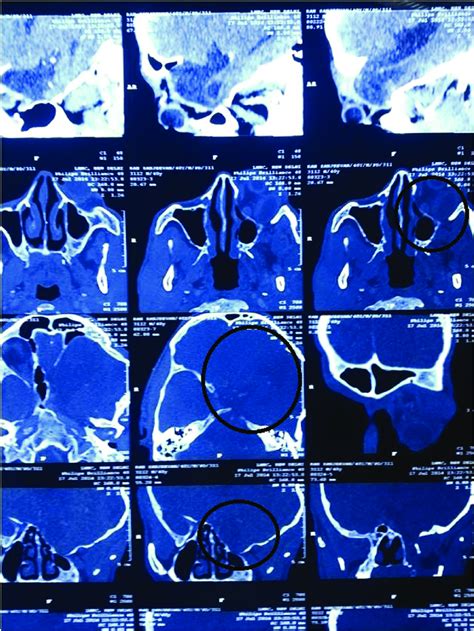 Contrast Enhanced Computed Tomography Head And Orbit Showing Left Sided