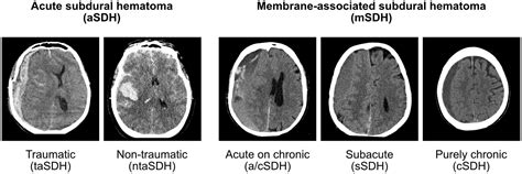 Acute Vs Chronic Subdural Hematoma