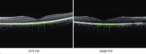 choroidal thickness was measured from the outer border of the retinal