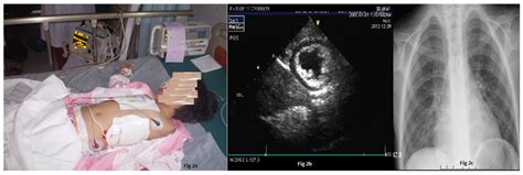 A Patient On Non Invasive Transcutaneous Pacing B Echocardiography Download Scientific