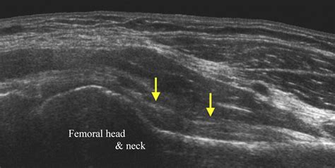 Ultrasonography Of The Hip And Lower Extremity Physical Medicine And