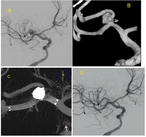 Right Mca Bifurcation Aneurysm Visible On Digital Subtraction