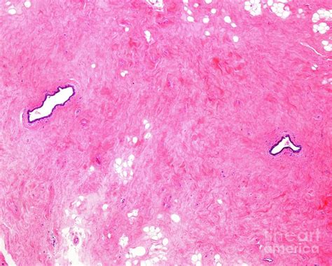 Breast Fibrosis Photograph By Jose Calvo Science Photo Library Pixels