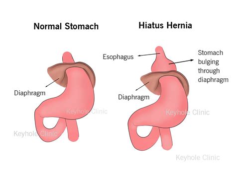 Hiatus Hernia How A Sliding Hiatus Hernia Forms Bupa Health