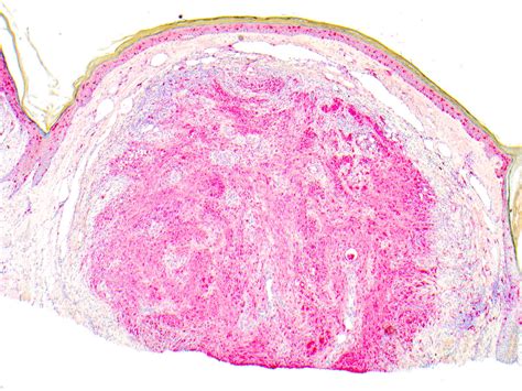 Pathology Outlines Cutaneous Neurocristic Hamartoma