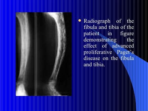 Pagets Disease Tibia Radiology At Marilyn Pierre Blog