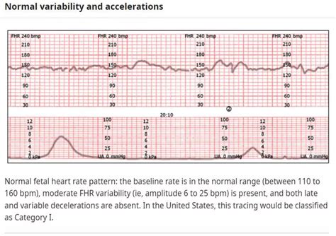 Fetal Cardiotocograph Ctgpptx
