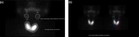 The Utility Of Technetium 99m Pertechnetate Thyroid Scintigr Nuclear Medicine Communications