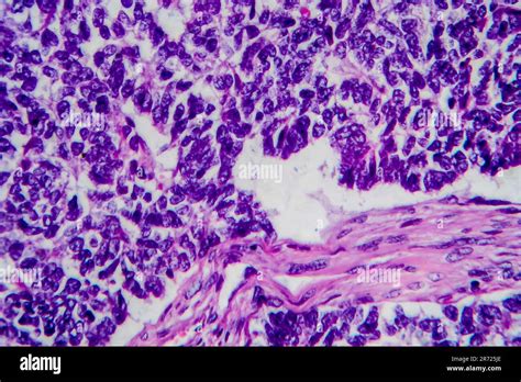 Wilms Tumor Or Nephroblastoma Light Micrograph Photo Under Microscope High Magnification