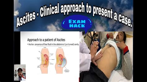 Ascites Clinical Approach How To Present A Case Final Year Mbbs