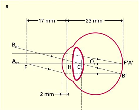 Formation Des Images Bonne Et Mauvaise Vues Vue 1 Média