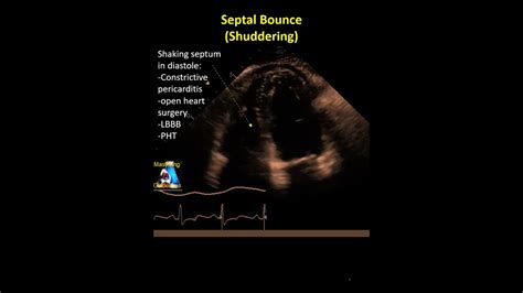Septal Bounce Shuddering Constrictive Pericarditis Education