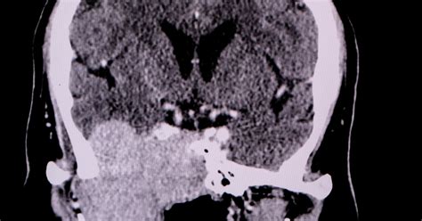 Pineal Region Tumors Types Symptoms Causes Diagnosis Staging