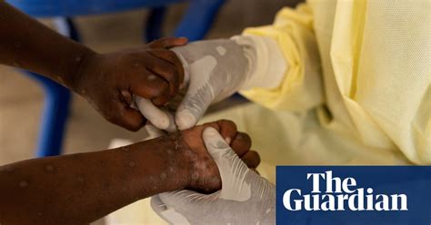 Africa Cdc Declares Mpox Outbreak A Public Health Emergency Mpox