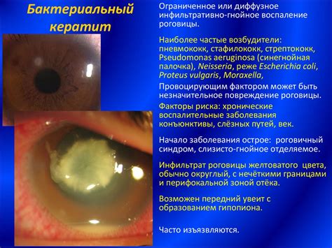 Кератиты - презентация онлайн