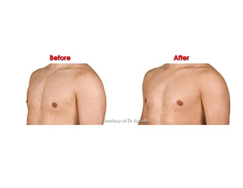 Macrolane For Natural Breast Augmentation By Dr Ayham Al Ayoubi Lma