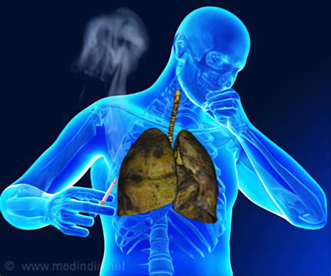 Tuberculosis Of The Brain Symptoms Uopry