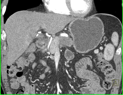 Pancreas Adenocarcinoma Pancreas Case Studies Ctisus Ct Scanning